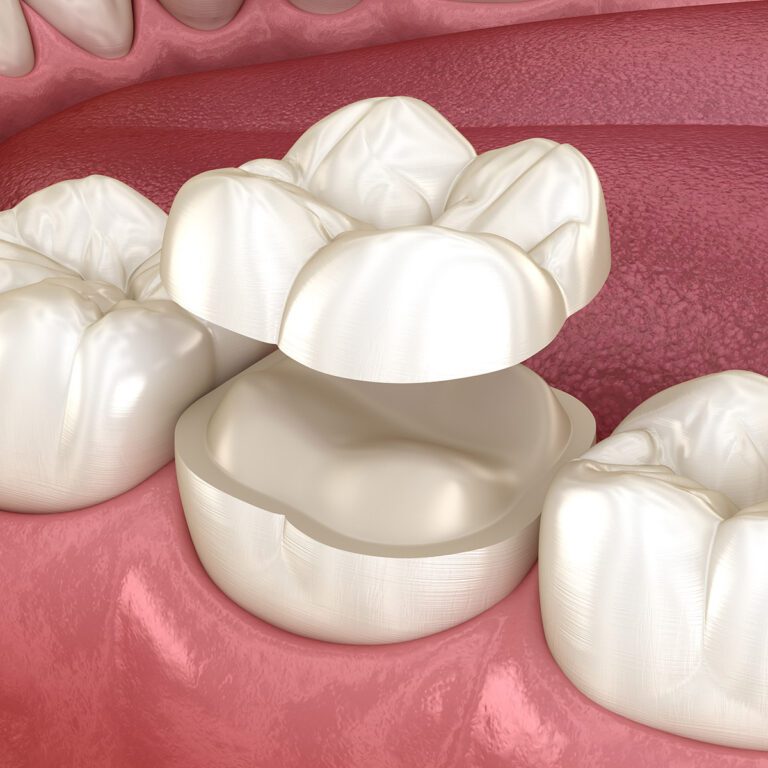 Inlays & Onlays in Abbotsford, BC | Overlays | Medora Dental Care