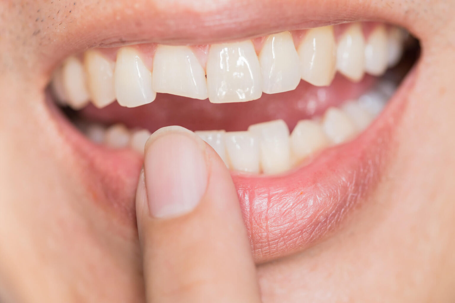How to Handle a Broken Tooth: Immediate Steps to Take | Medora Dental ...